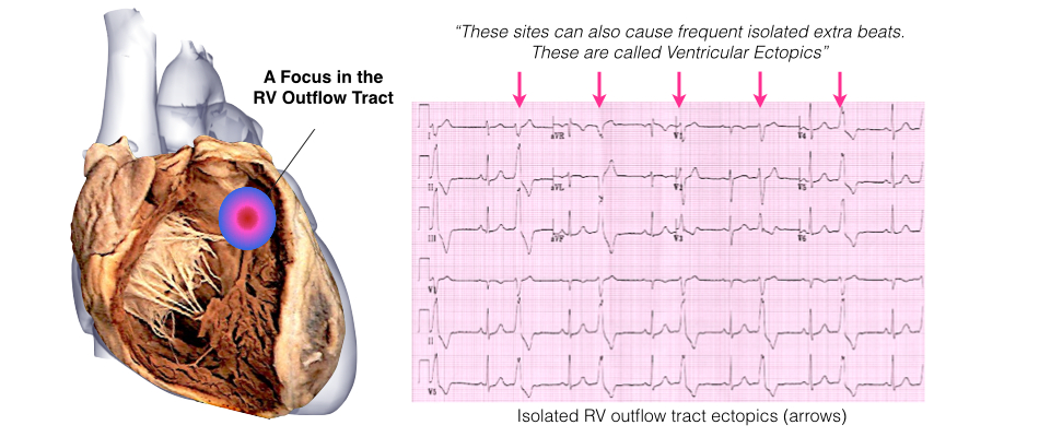 Ventricular Tachycardia in Normal Hearts (Idiopathic VT) - Melbourne ...